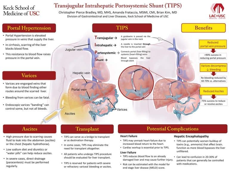 Transjugular Intrahepatic Portosystemic Shunt (TIPS) - American Liver ... Transjugular Intrahepatic Portosystemic Shunt (TIPS) - American Liver ...