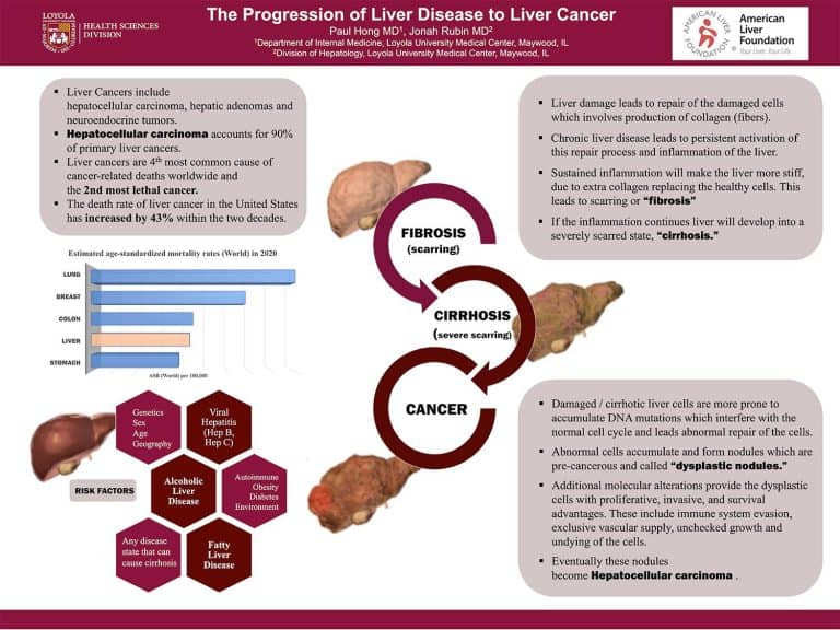 The Progression of Liver Disease to Liver Cancer - American Liver ...