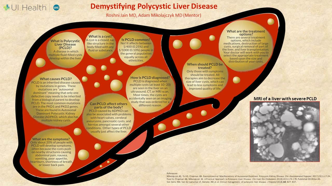 Demystifying Polycystic Liver Disease - American Liver Foundation