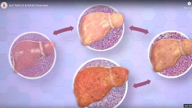 Nichtalkoholische Fettlebererkrankung (NAFLD)