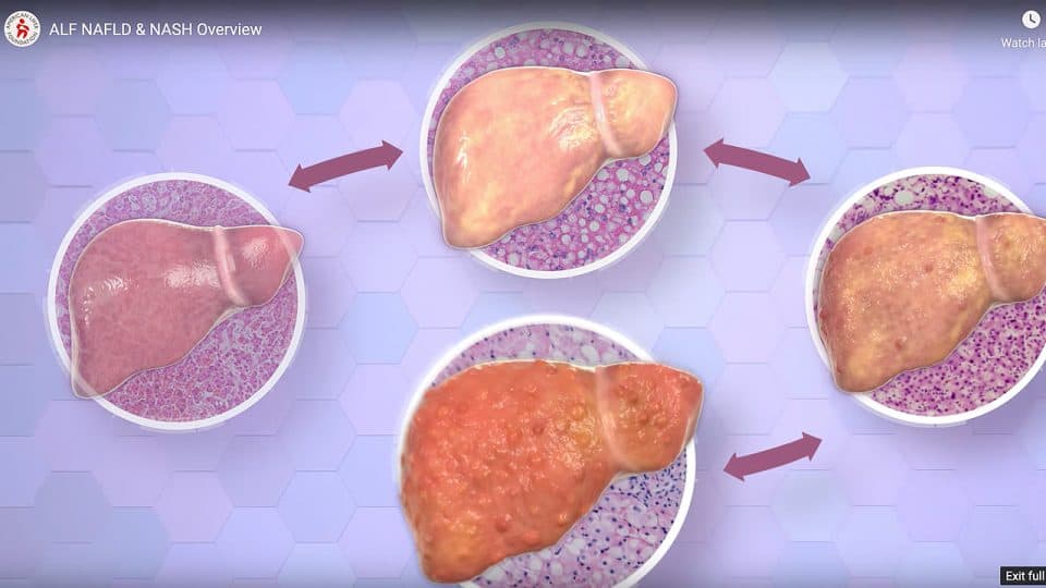 Nonalcoholic Fatty Liver Disease (NAFLD)